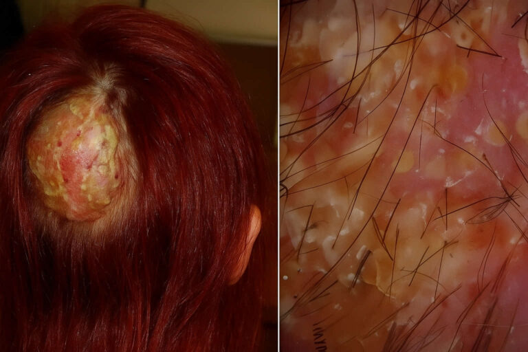 Kerion Celsi: A Infecção Fúngica Que Pode Apodrecer Seu Couro Cabeludo ...